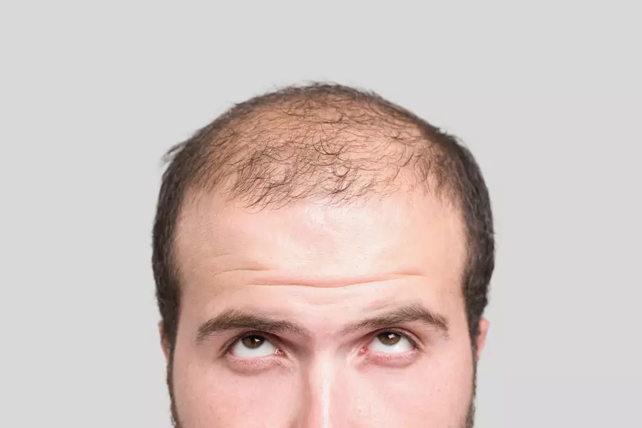 6 Common Hair Loss Causes yn manlju 10289_1