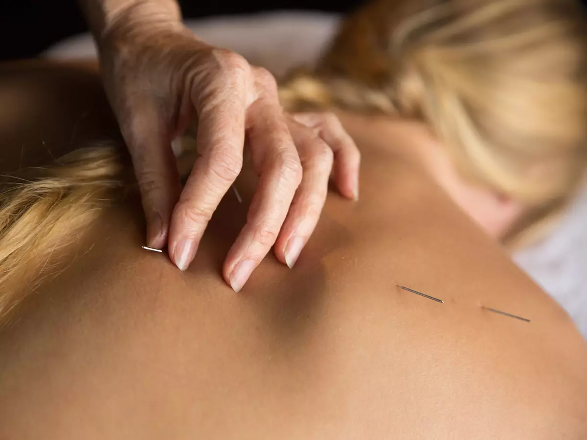muller que recibe un tratamento de acupuntura na sala de masaxe mo